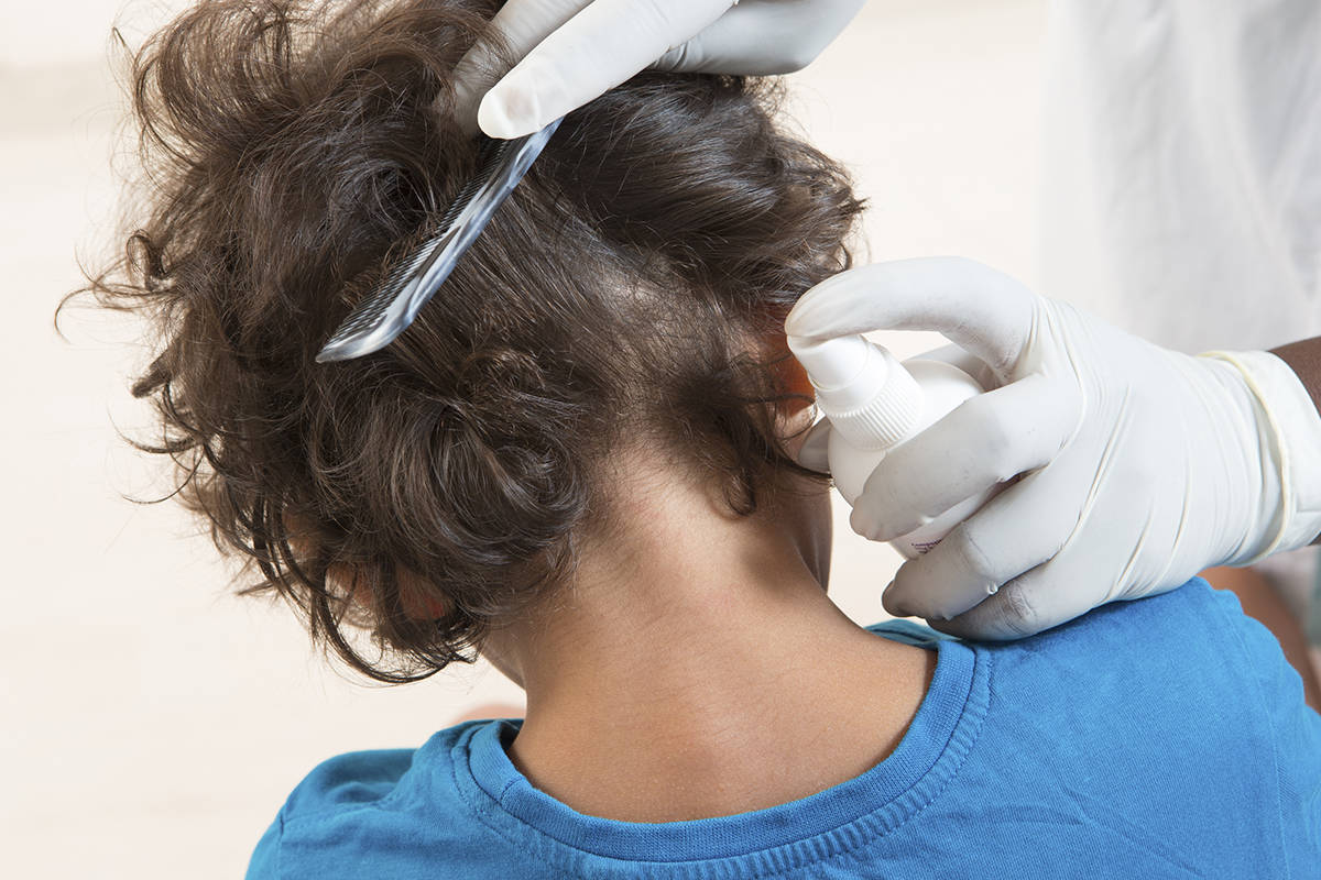 Head Lice | What Does Lice Look Like, How to Get Rid of Lice, Hair Lice